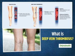 Deep Vein Thrombosis (DVT) | Fayette Surgical Associates